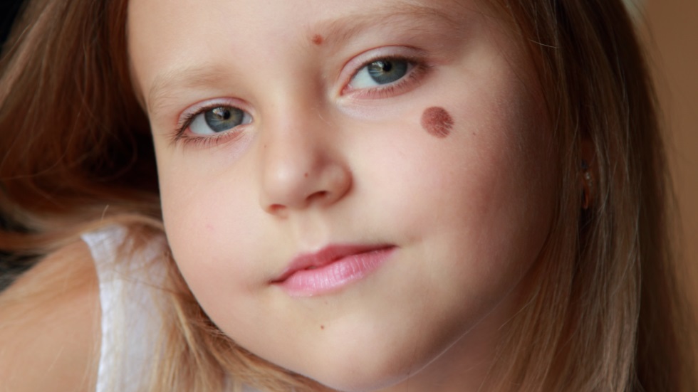 S-a născut cu peste 500 de semne pe corp și era poreclită „Dalmațiana ...