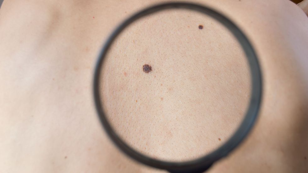 Alunițele cancerigene. Cum le recunoști și cum te protejezi de ele ...